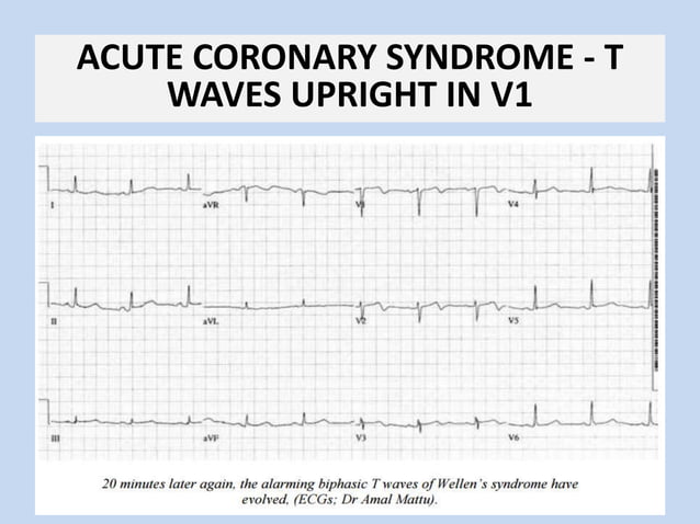 Stemi equivalents | PPT