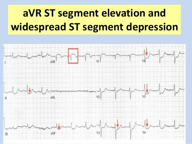 Stemi equivalents