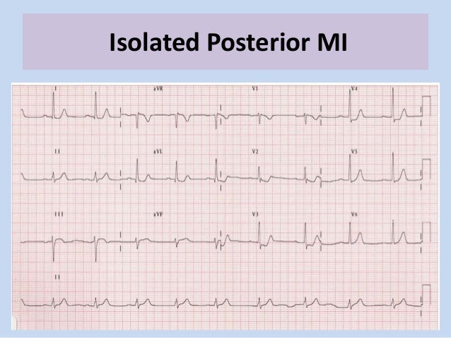 Stemi equivalents