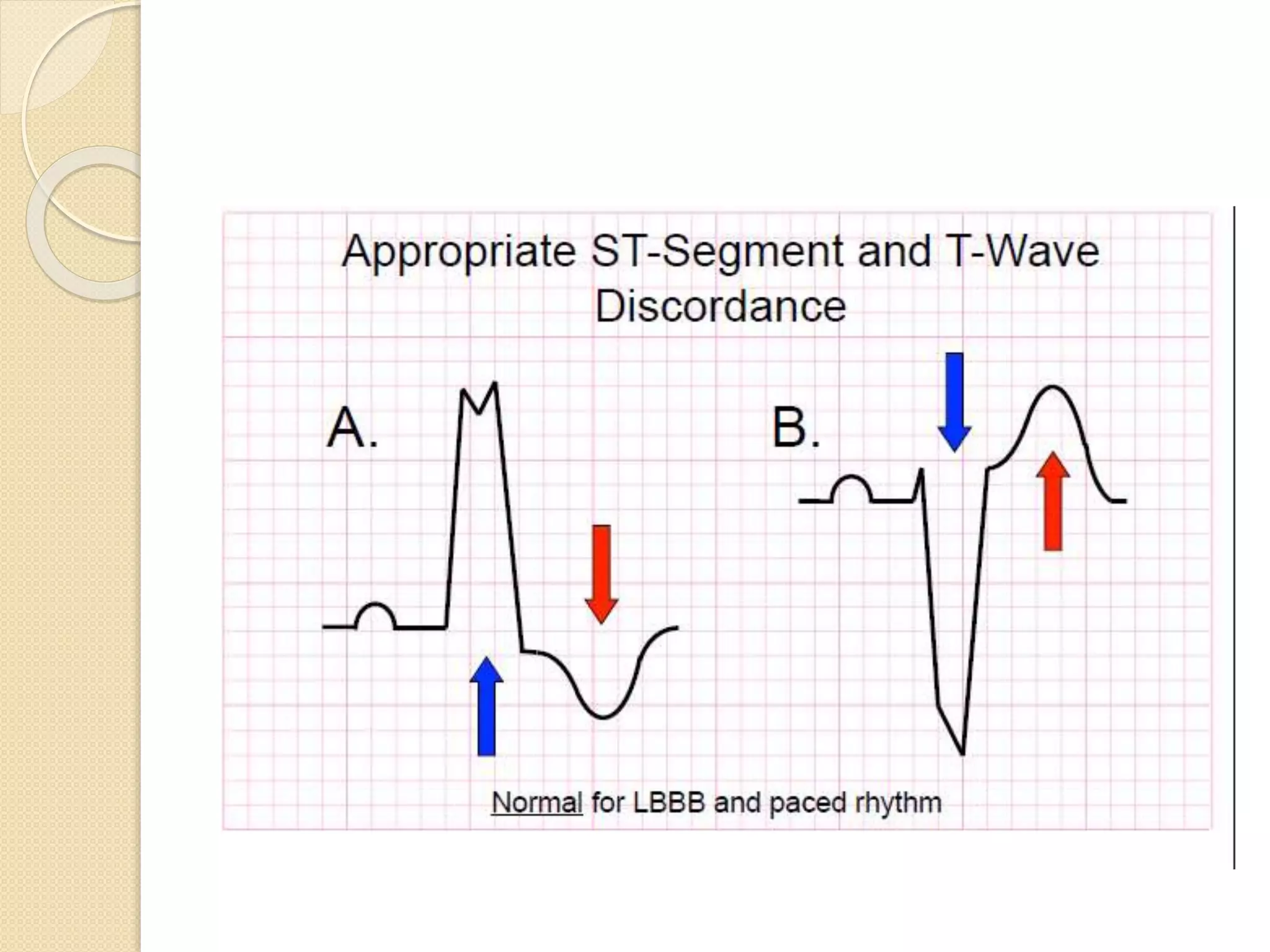 STEMI equivalents- ECG update | PPTX