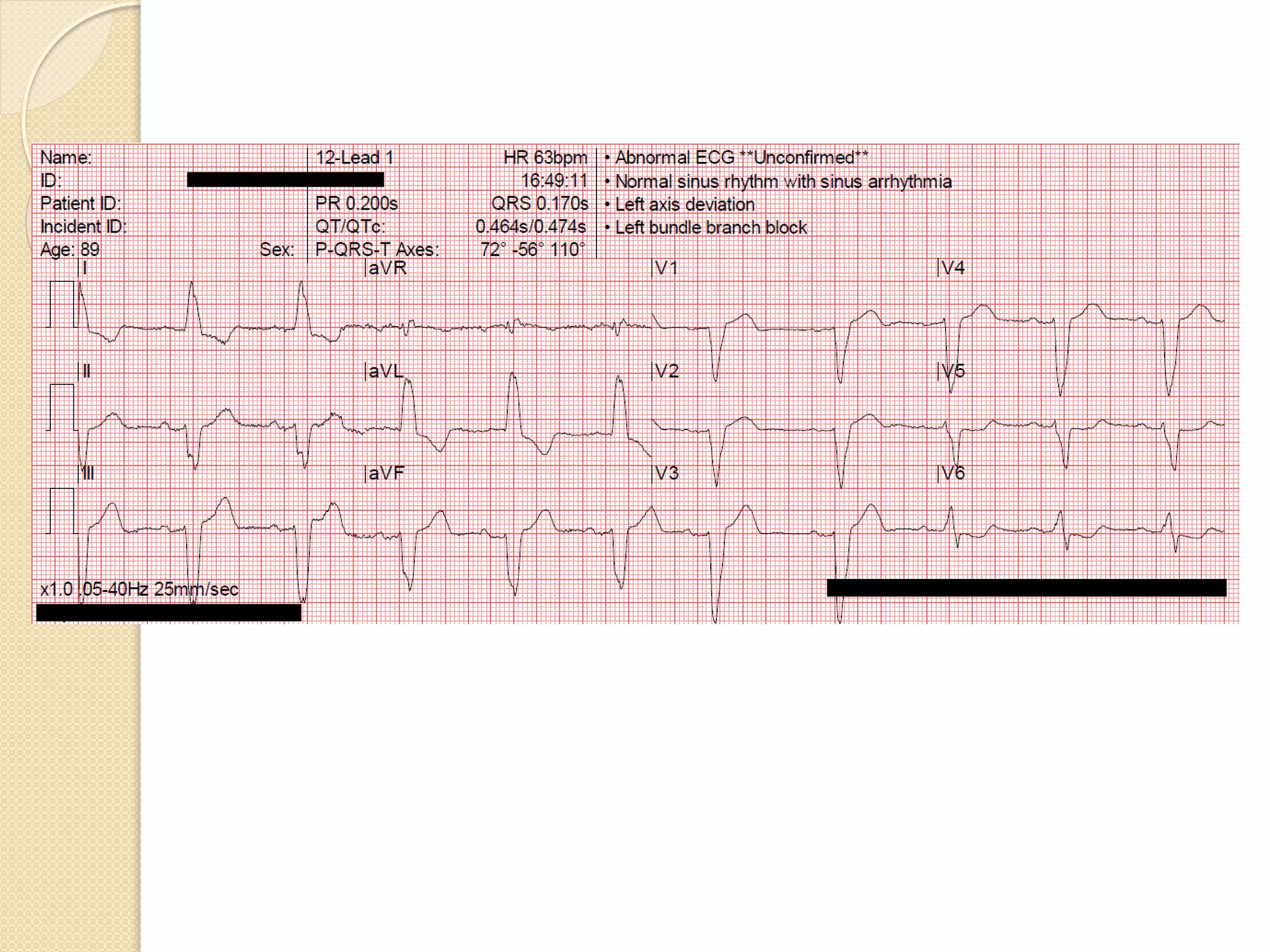 STEMI equivalents- ECG update | PPTX