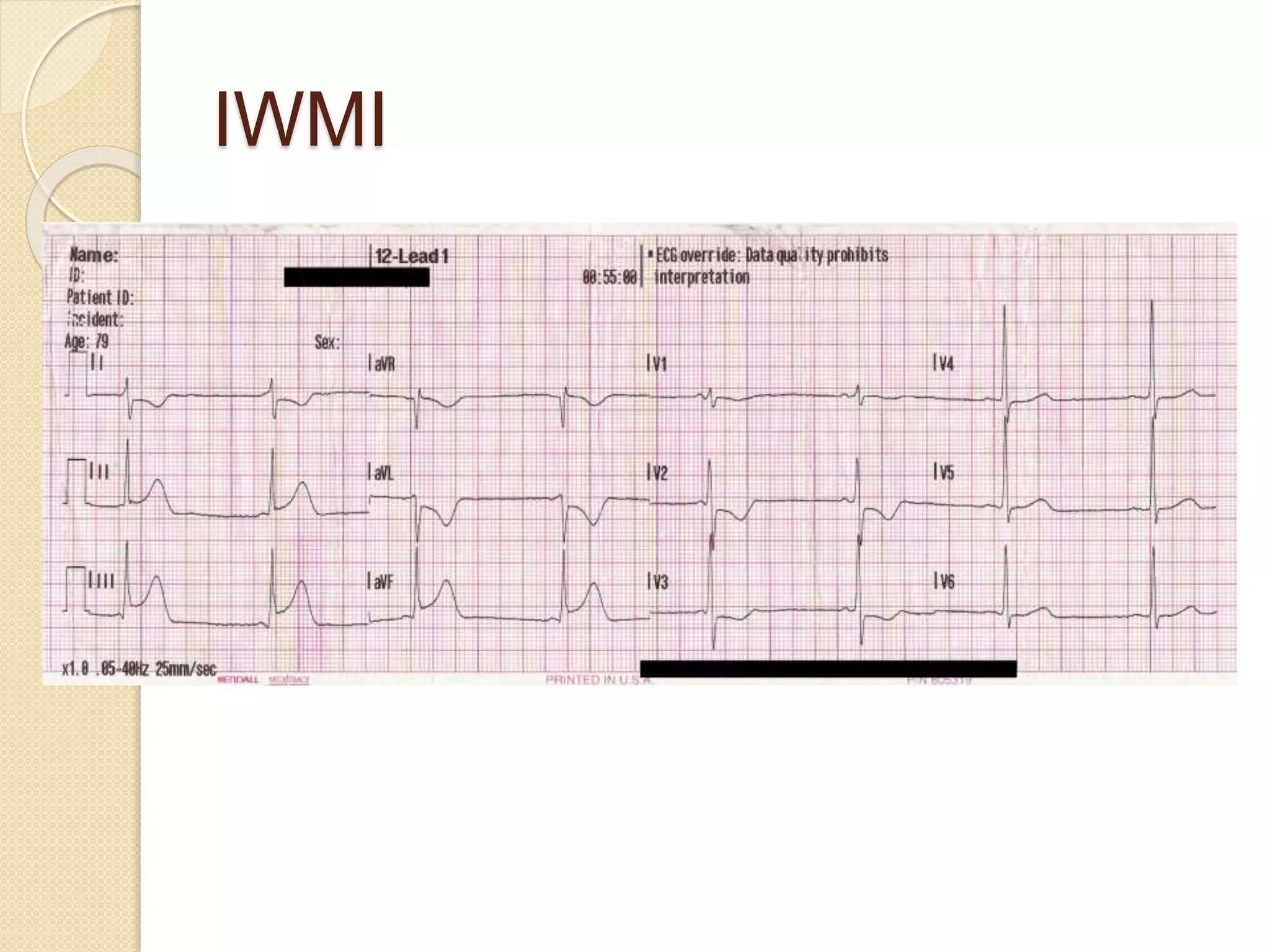 STEMI equivalents- ECG update | PPTX