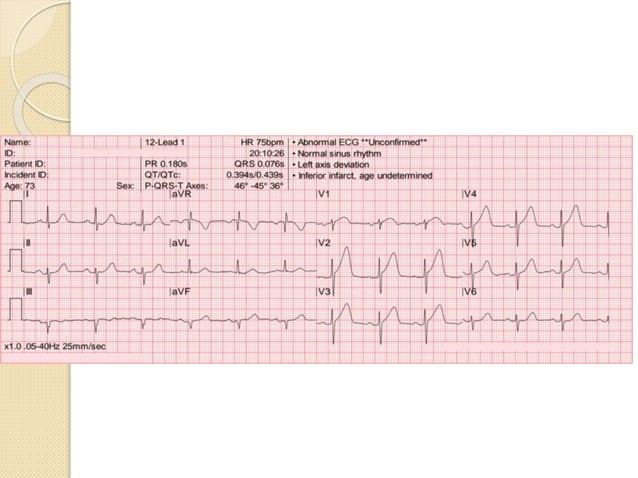 STEMI equivalents- ECG update | PPTX | Heart and Cardiovascular ...