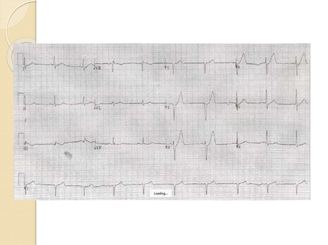 STEMI equivalents- ECG update | PPTX | Heart and Cardiovascular ...