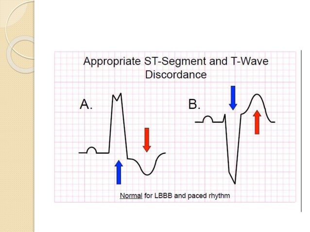 STEMI equivalents- ECG update | PPTX | Heart and Cardiovascular ...