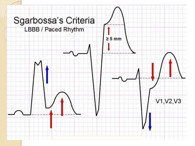 STEMI equivalents- ECG update | PPTX | Heart and Cardiovascular ...