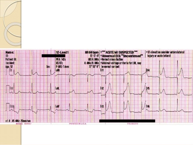 What are contiguous leads - pagadvanced
