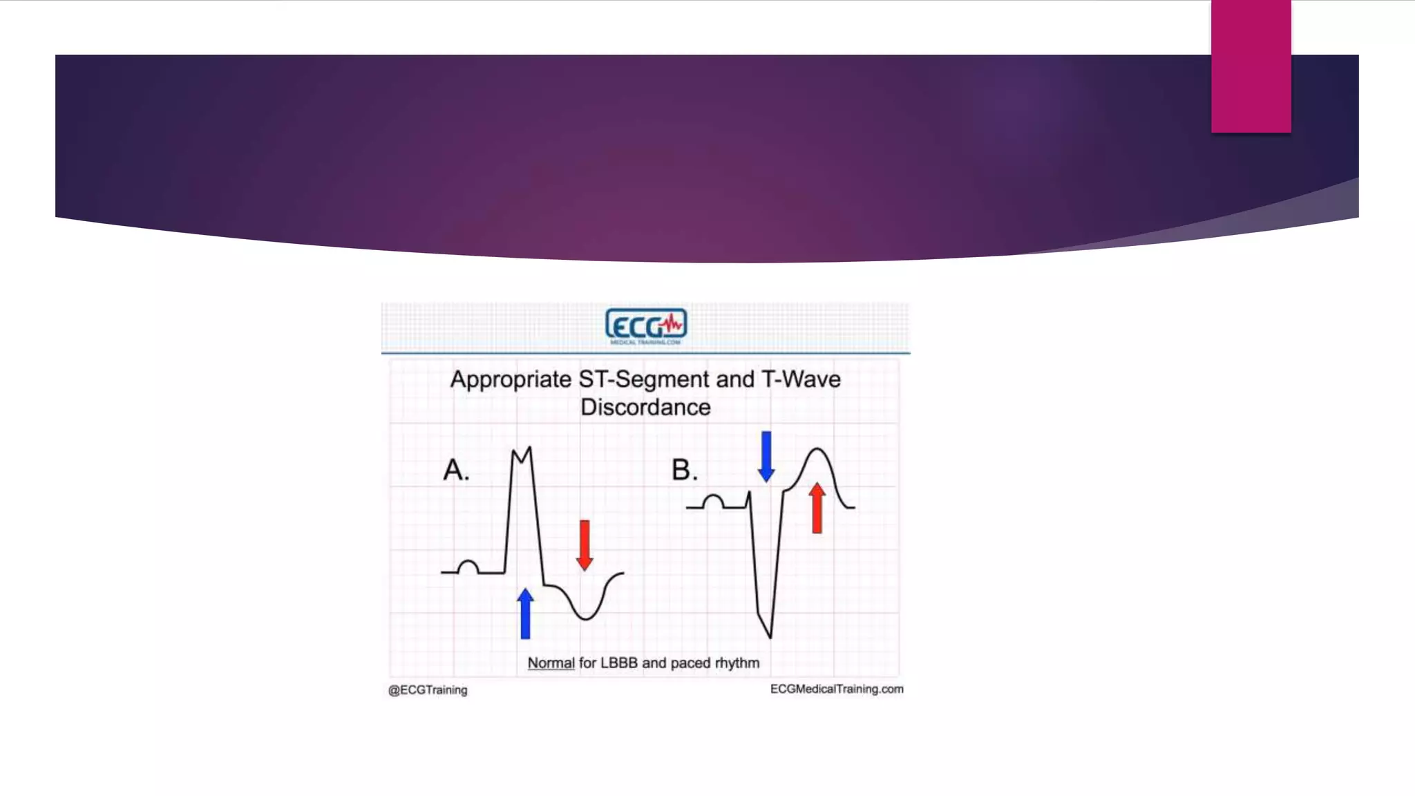 STEMI equivalents | PPTX