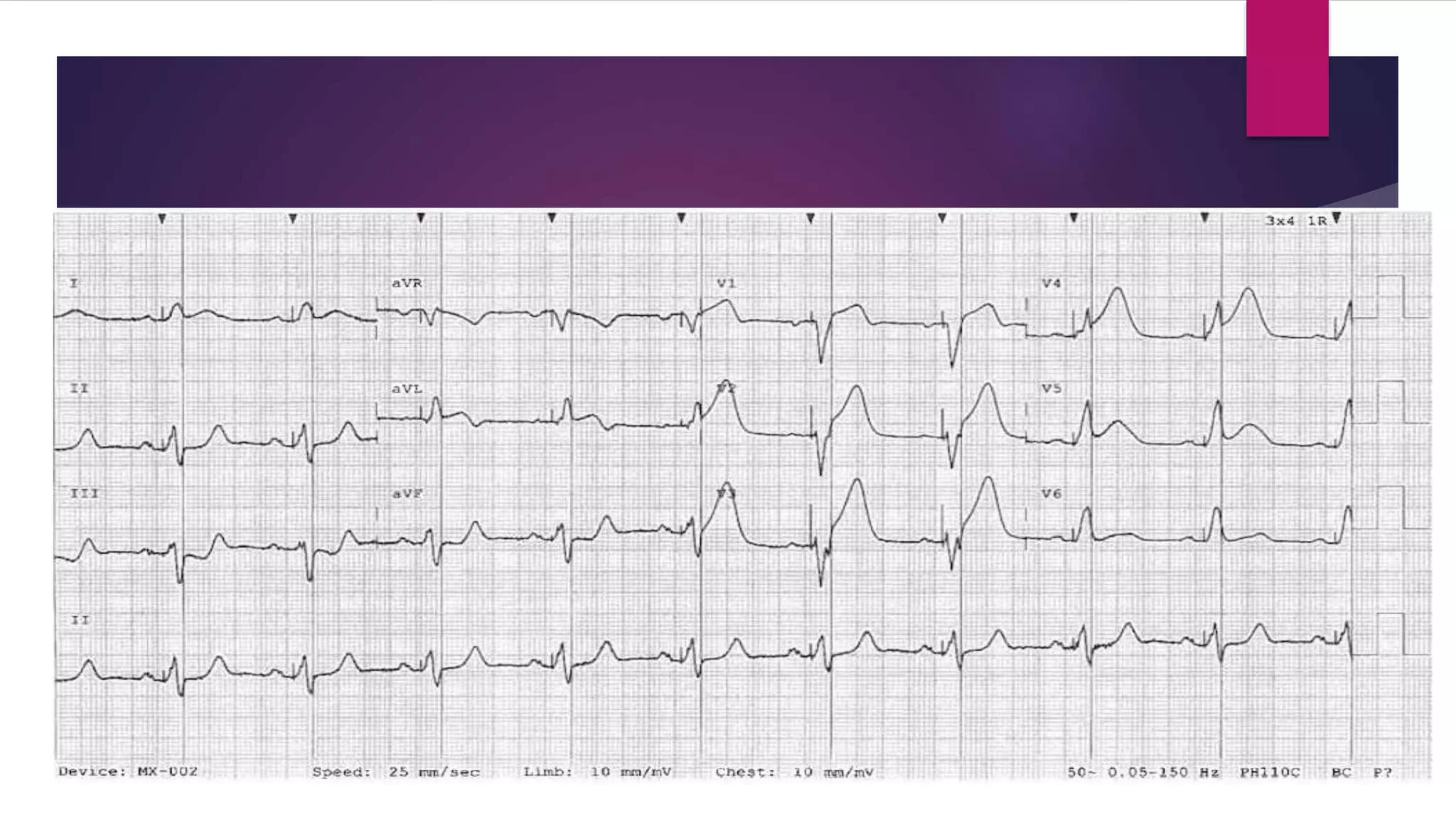 STEMI equivalents | PPTX