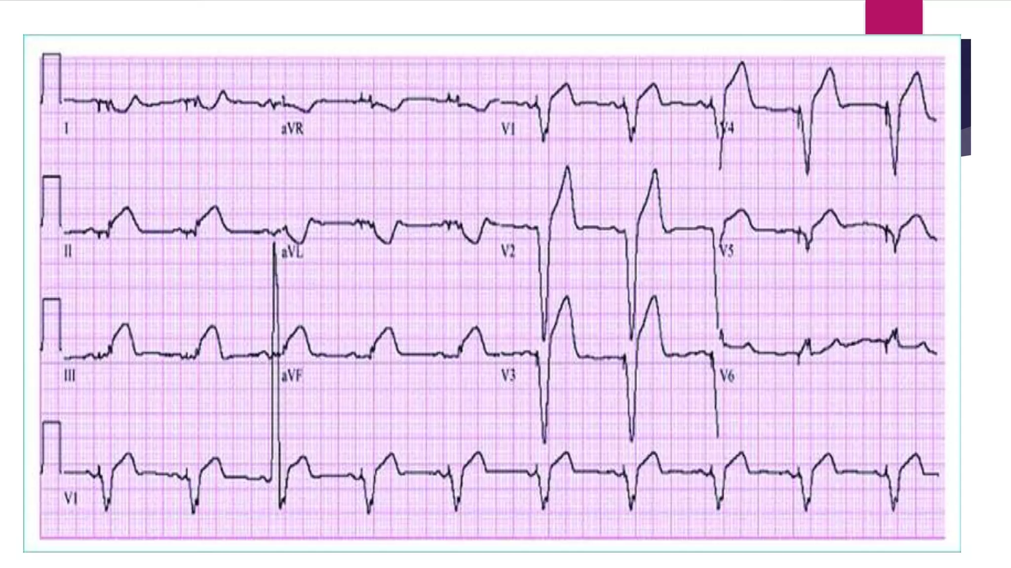 STEMI equivalents | PPTX