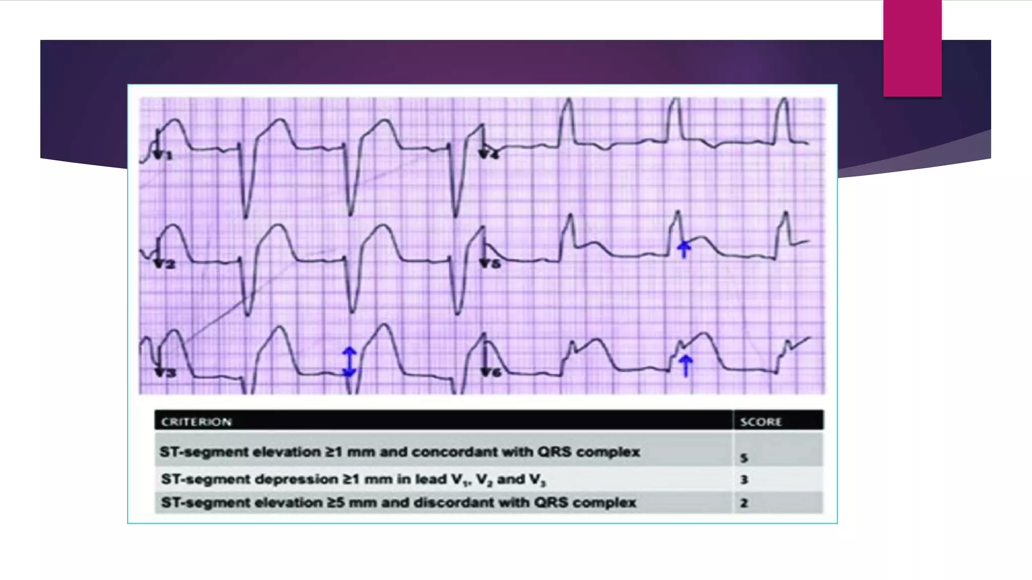 STEMI equivalents | PPTX