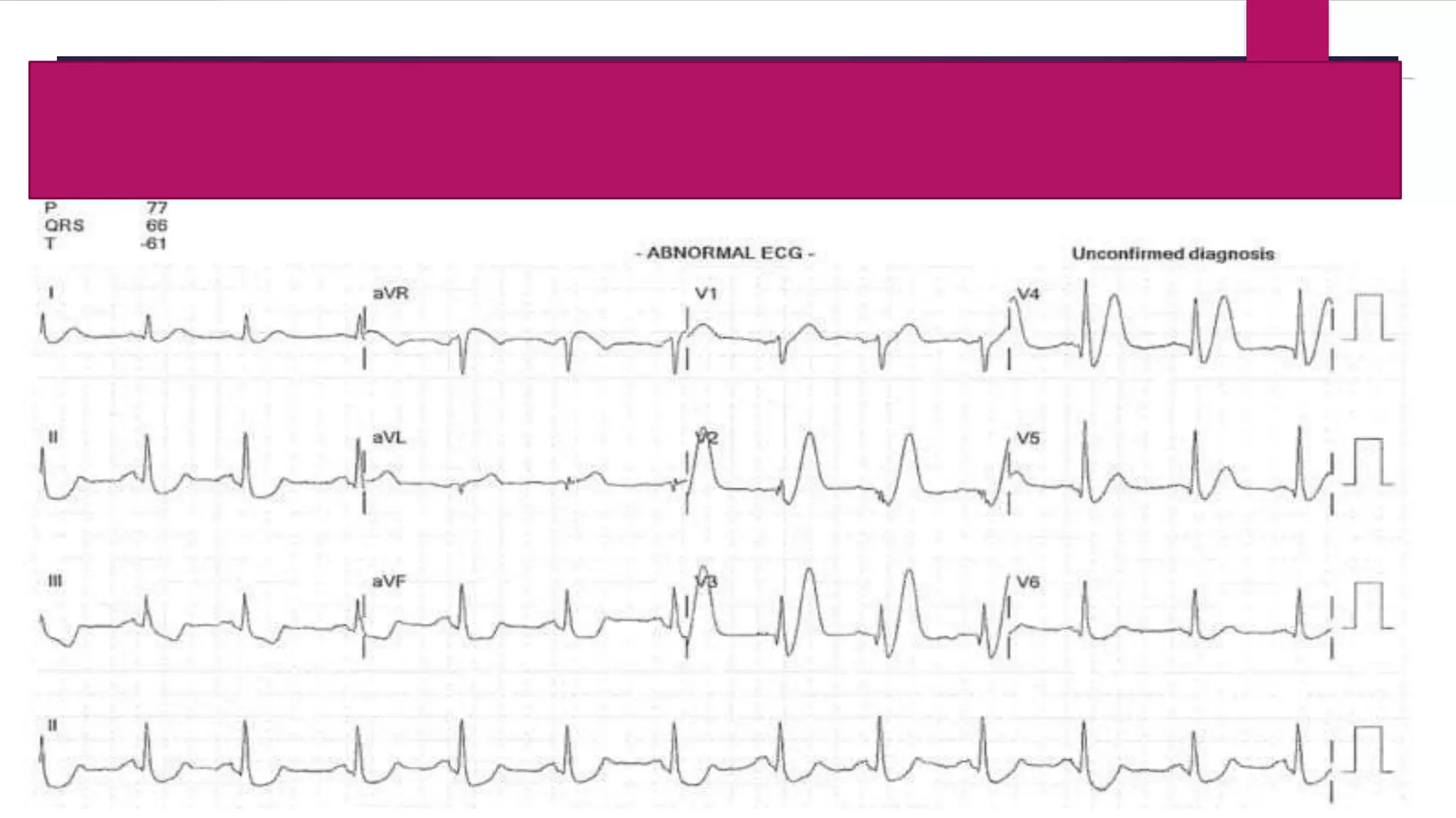 STEMI equivalents | PPTX