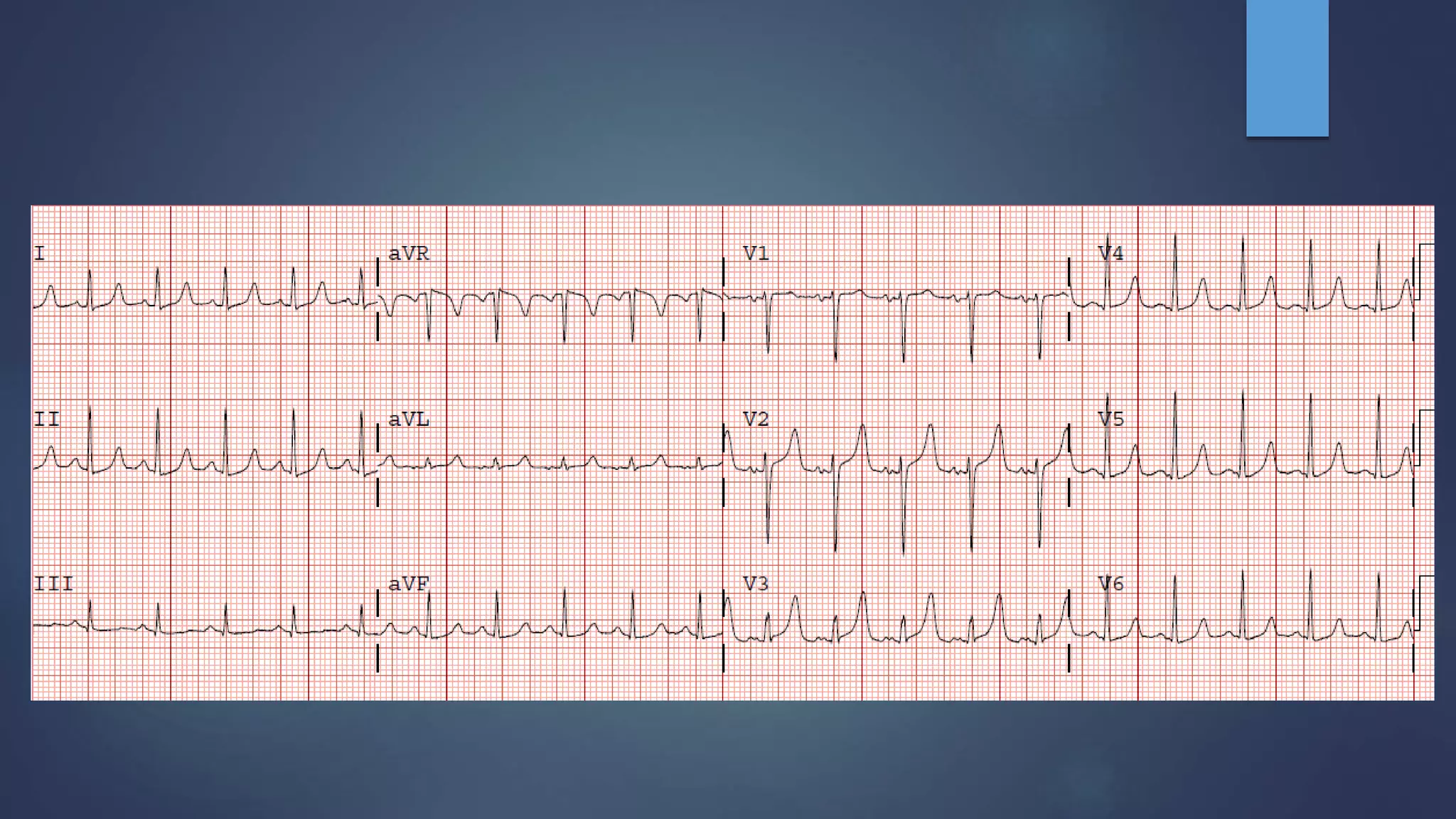 Stemi equivalents | PPTX