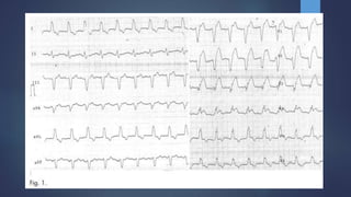 Stemi equivalents | PPTX