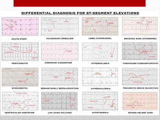 STEMI F5.pptx | First Aid | Injuries