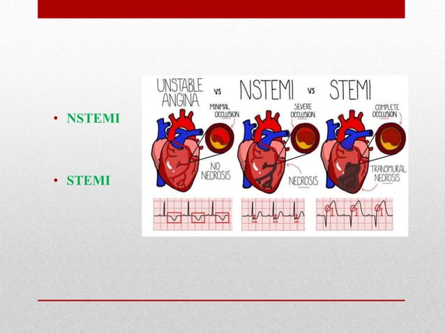 STEMI F5.pptx | First Aid | Injuries
