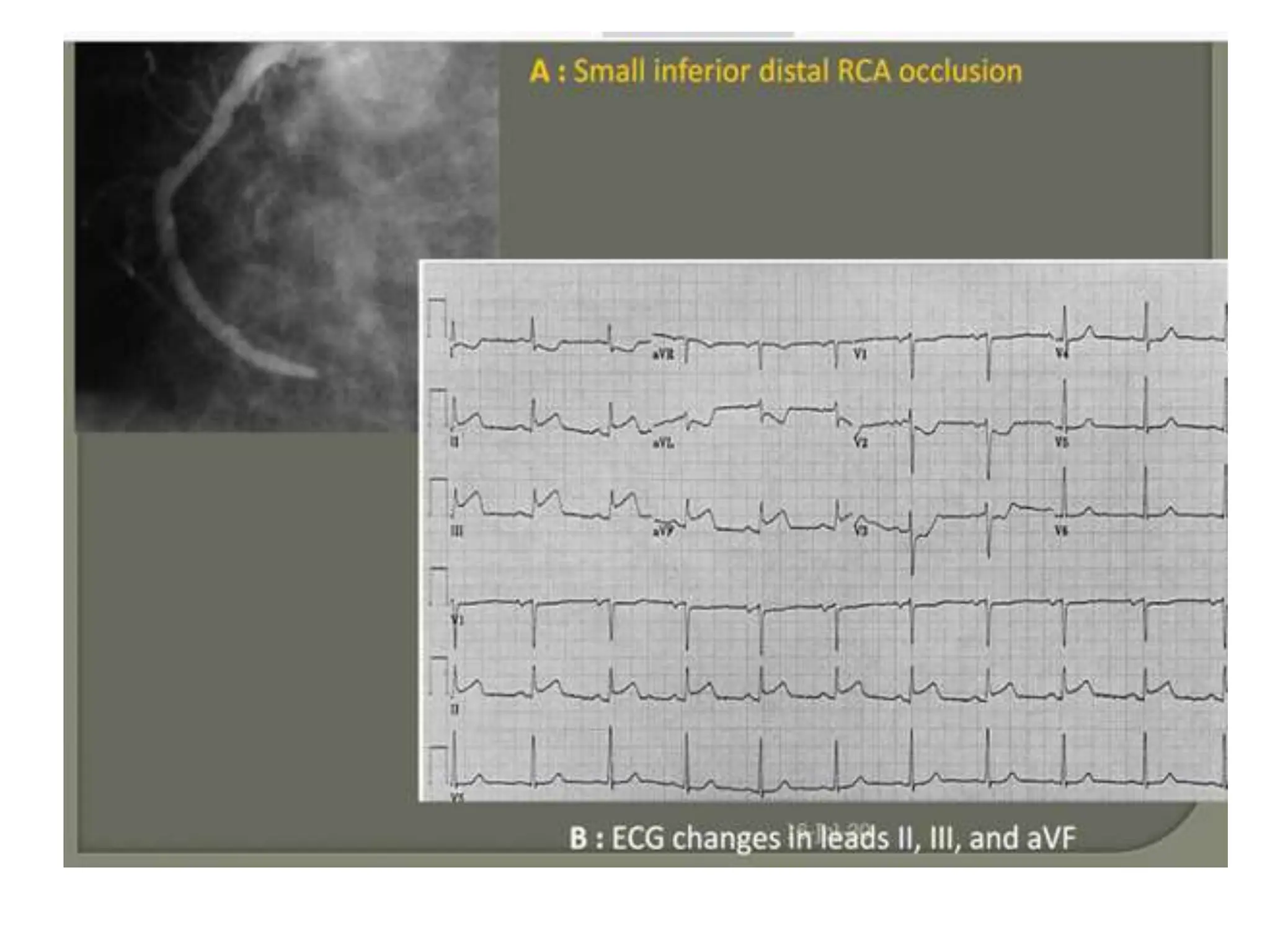 STEMI INFERO POSTERIOR+RV INFARK+TAVB.pptx