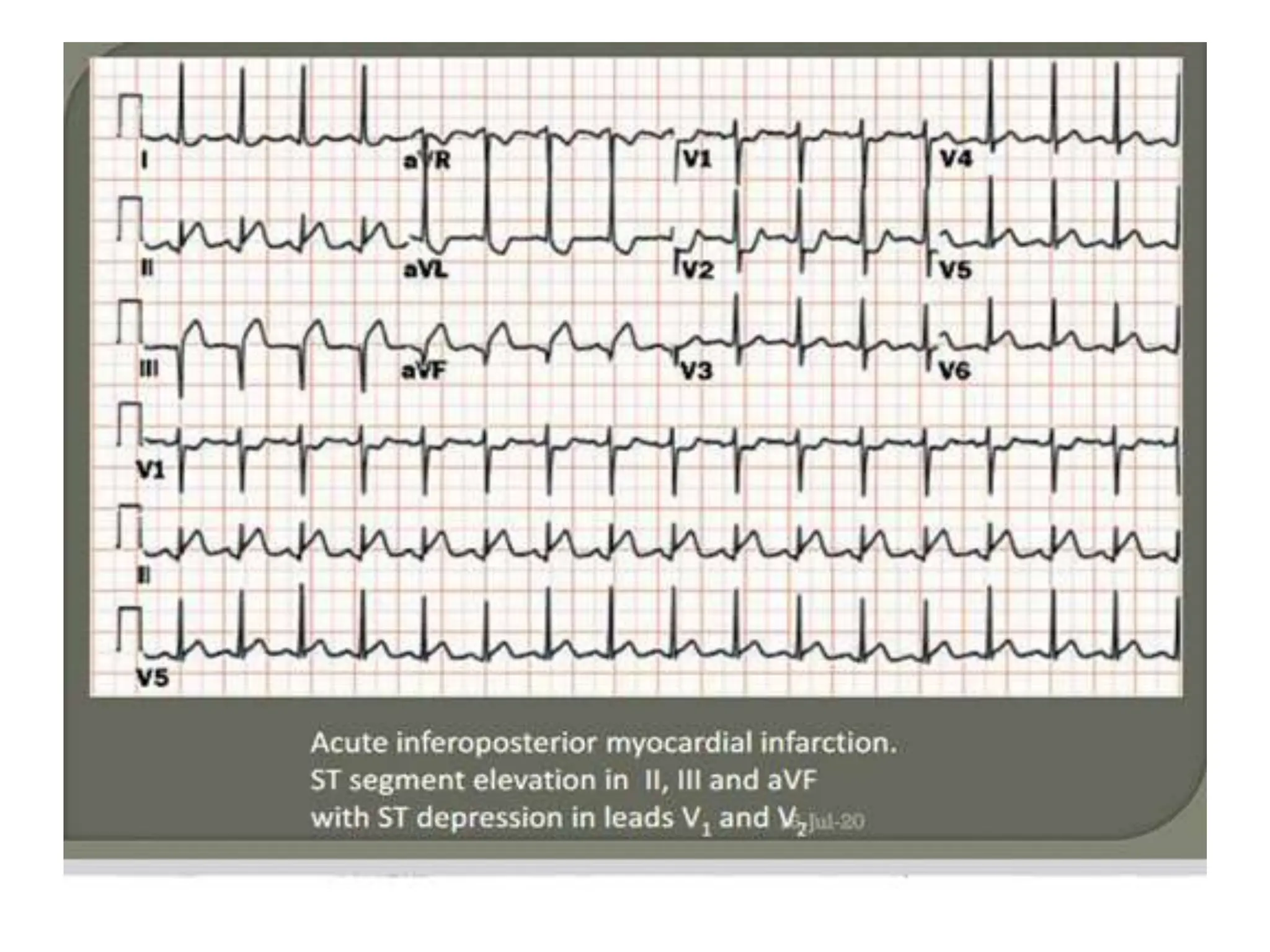 STEMI INFERO POSTERIOR+RV INFARK+TAVB.pptx
