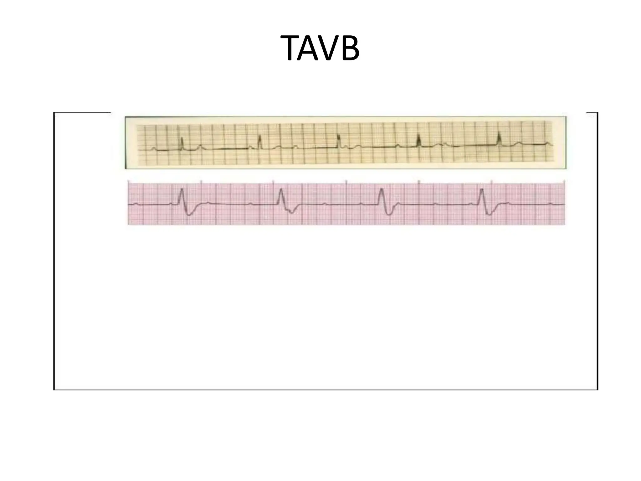 STEMI INFERO POSTERIOR+RV INFARK+TAVB.pptx
