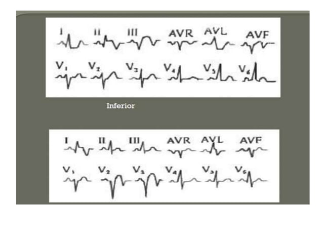STEMI INFERO POSTERIOR+RV INFARK+TAVB.pptx