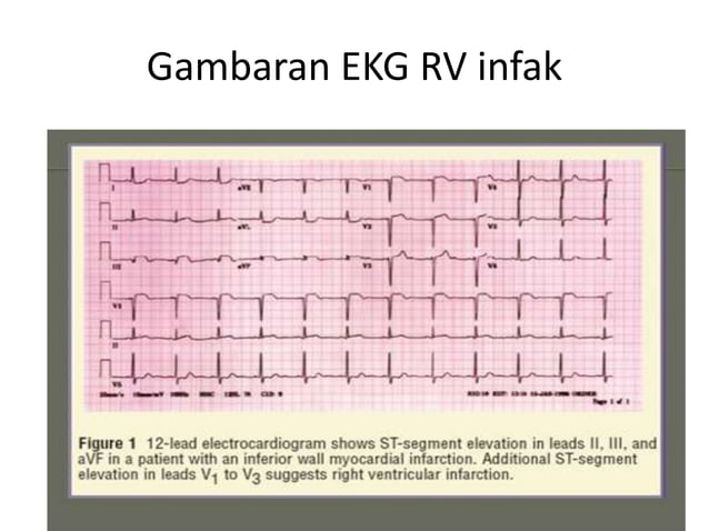 STEMI INFERO POSTERIOR+RV INFARK+TAVB.pptx