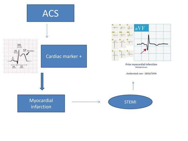STEMI INFERO POSTERIOR+RV INFARK+TAVB.pptx
