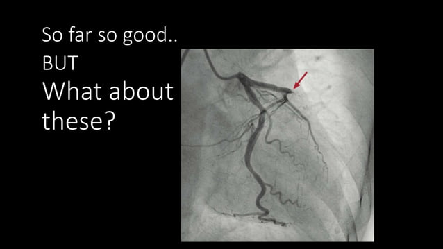 STEMI Late Presentation - Management and practical approach | PPTX ...