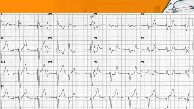 STEMI Mimic WHAT IS IT AND HOW TO IDENTIFY IT ? | PPT