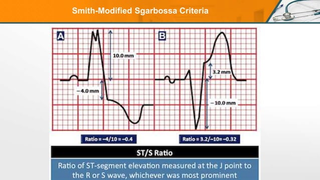 STEMI Mimic WHAT IS IT AND HOW TO IDENTIFY IT ? | PPT