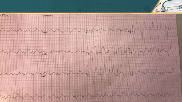 STEMI Mimic WHAT IS IT AND HOW TO IDENTIFY IT ? | PPT