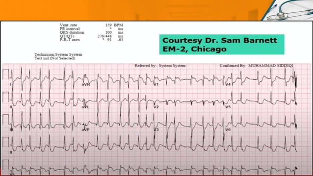 STEMI Mimic WHAT IS IT AND HOW TO IDENTIFY IT ? | PPT