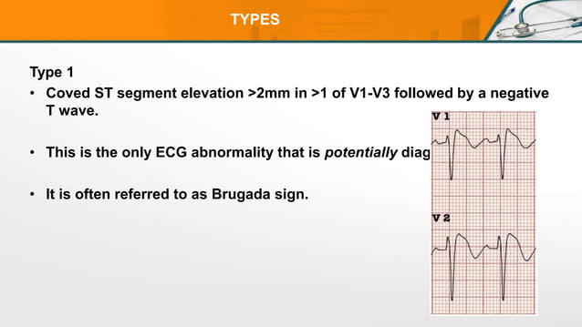 STEMI Mimic WHAT IS IT AND HOW TO IDENTIFY IT ? | PPT