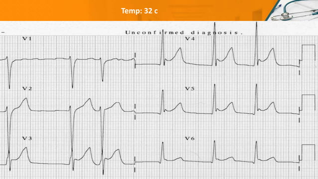 STEMI Mimic WHAT IS IT AND HOW TO IDENTIFY IT ? | PPT