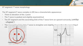STEMI Mimic WHAT IS IT AND HOW TO IDENTIFY IT ? | PPTX