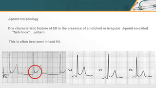 STEMI Mimic WHAT IS IT AND HOW TO IDENTIFY IT ? | PPTX