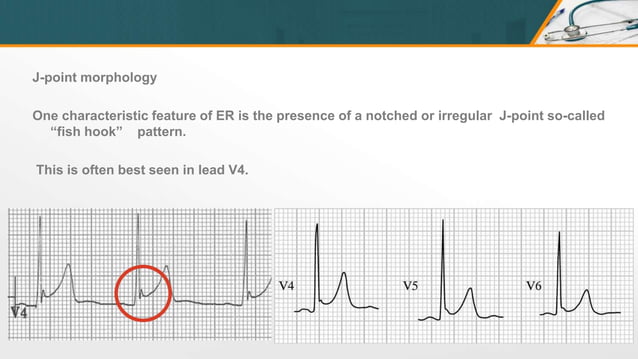 STEMI Mimic WHAT IS IT AND HOW TO IDENTIFY IT ? | PPT