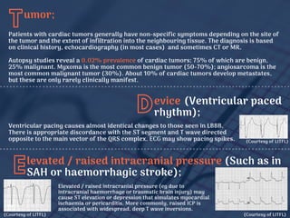 Stemi mimics v2 teaching resource | PDF