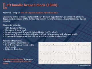 Stemi mimics v2 teaching resource | PDF