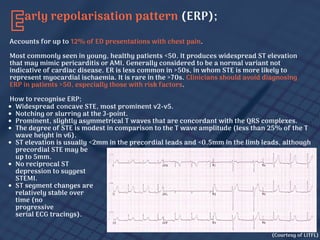 Stemi mimics v2 teaching resource | PDF