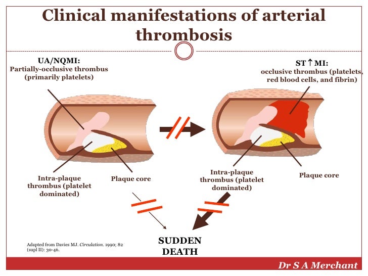 STEMI – My Approach 2010
