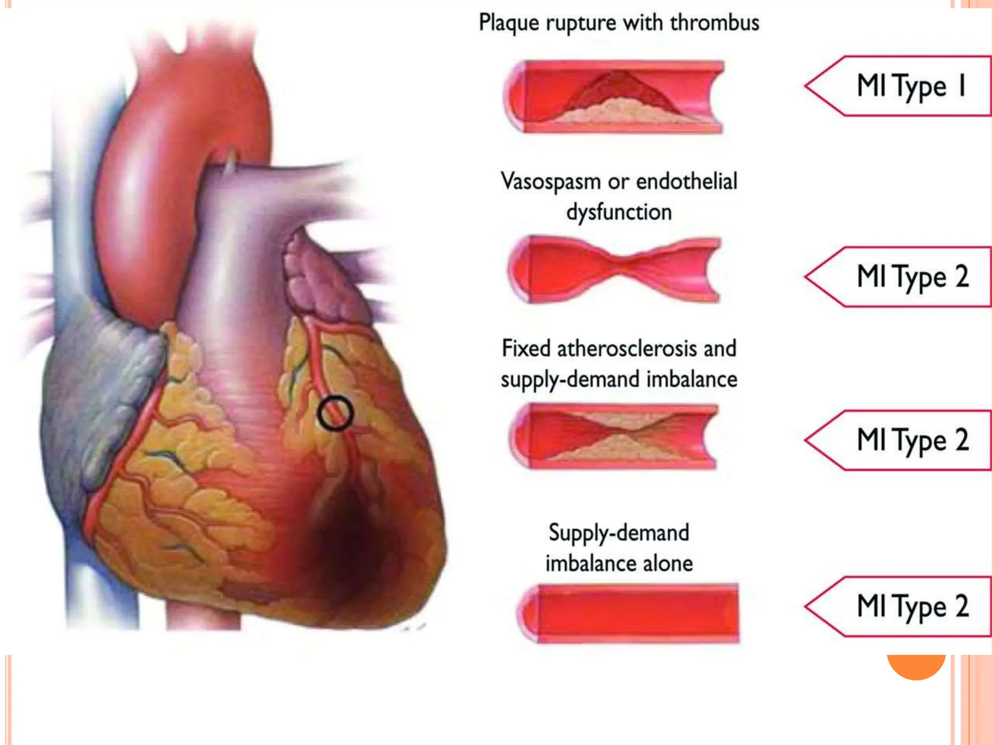 ppt on STEMI IN ICU, FOR acute coronary syndrome | PPTX