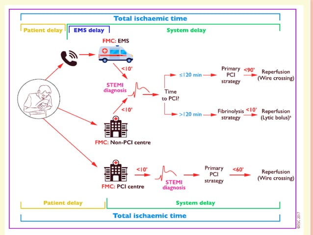 STEMI MANAGEMENT IN ICU FOR NURSES AND DOCTORS | PPT