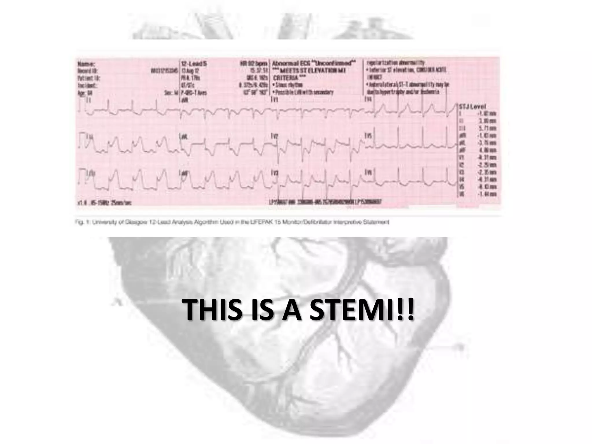 Stemi or no stemi | PPTX