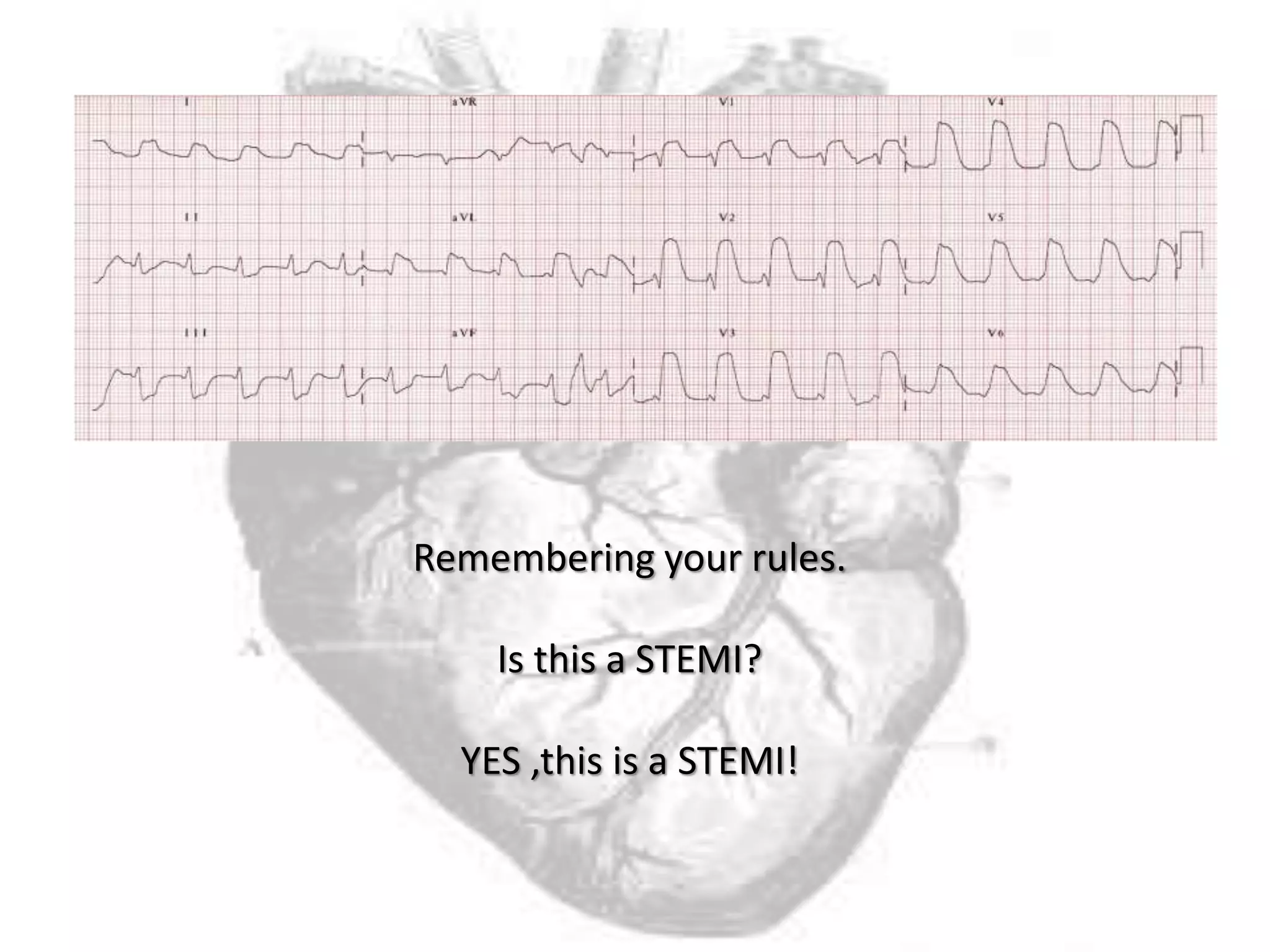 Stemi or no stemi | PPTX
