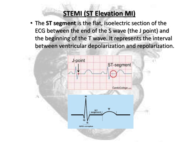 Stemi or no stemi | PPTX