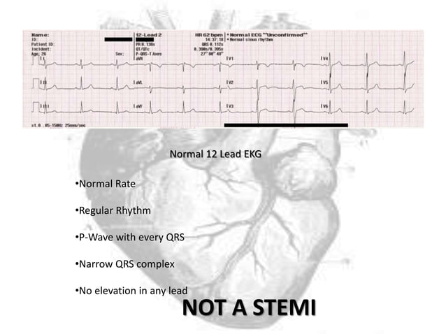 Stemi or no stemi | PPTX