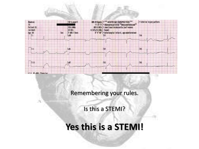 Stemi or no stemi | PPTX