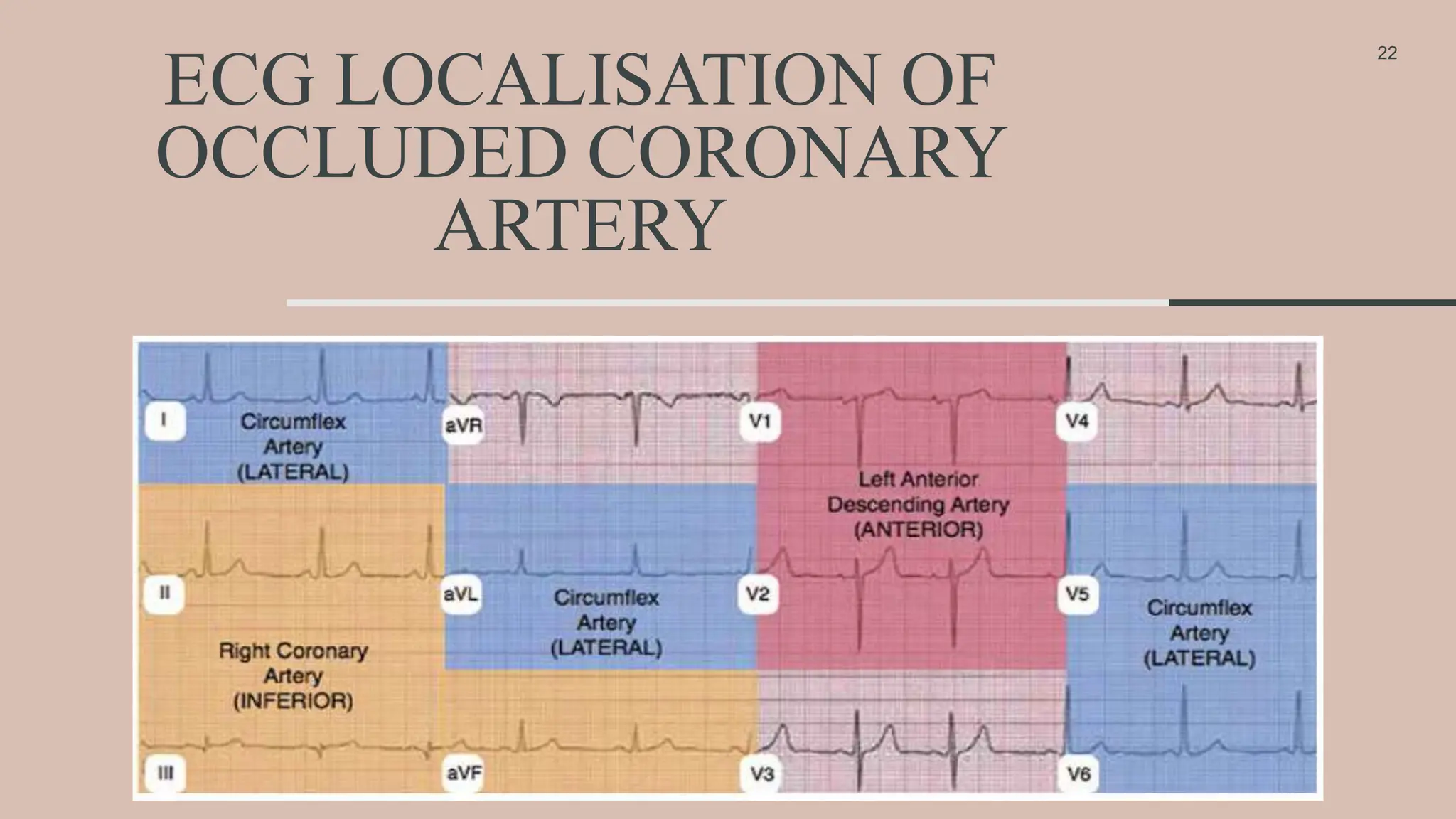 STEMI PPT for acute coronary syndome acute MI | PPTX