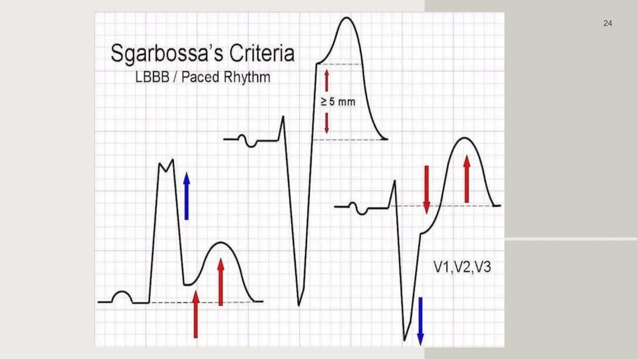 STEMI PPT for acute coronary syndome acute MI | PPTX