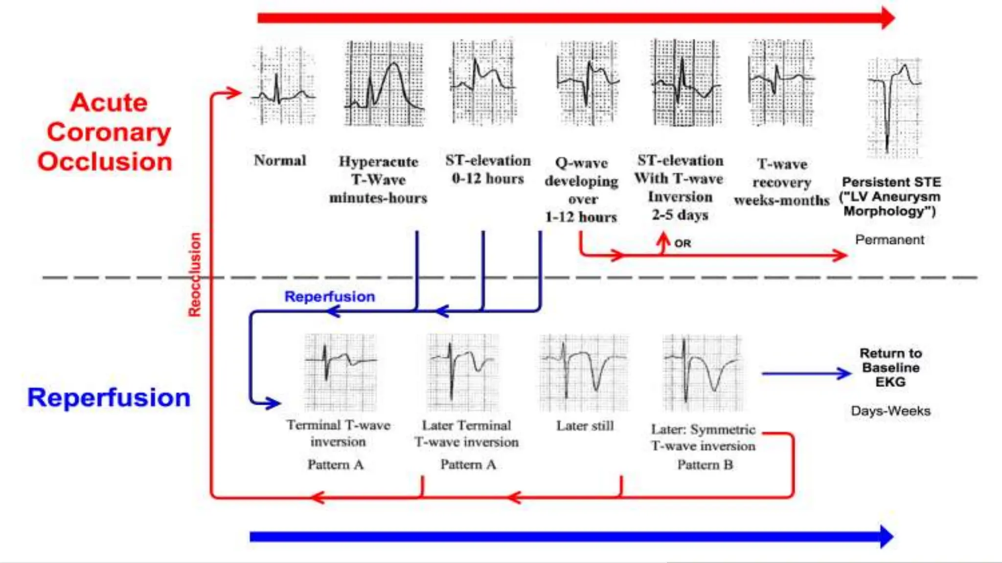 STEMI PPT for acute coronary syndome acute MI | PPTX